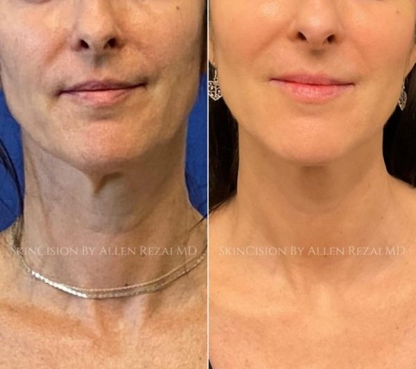 The Complete Morpheus8 Guide at SkinCision By Allen Rezai MD